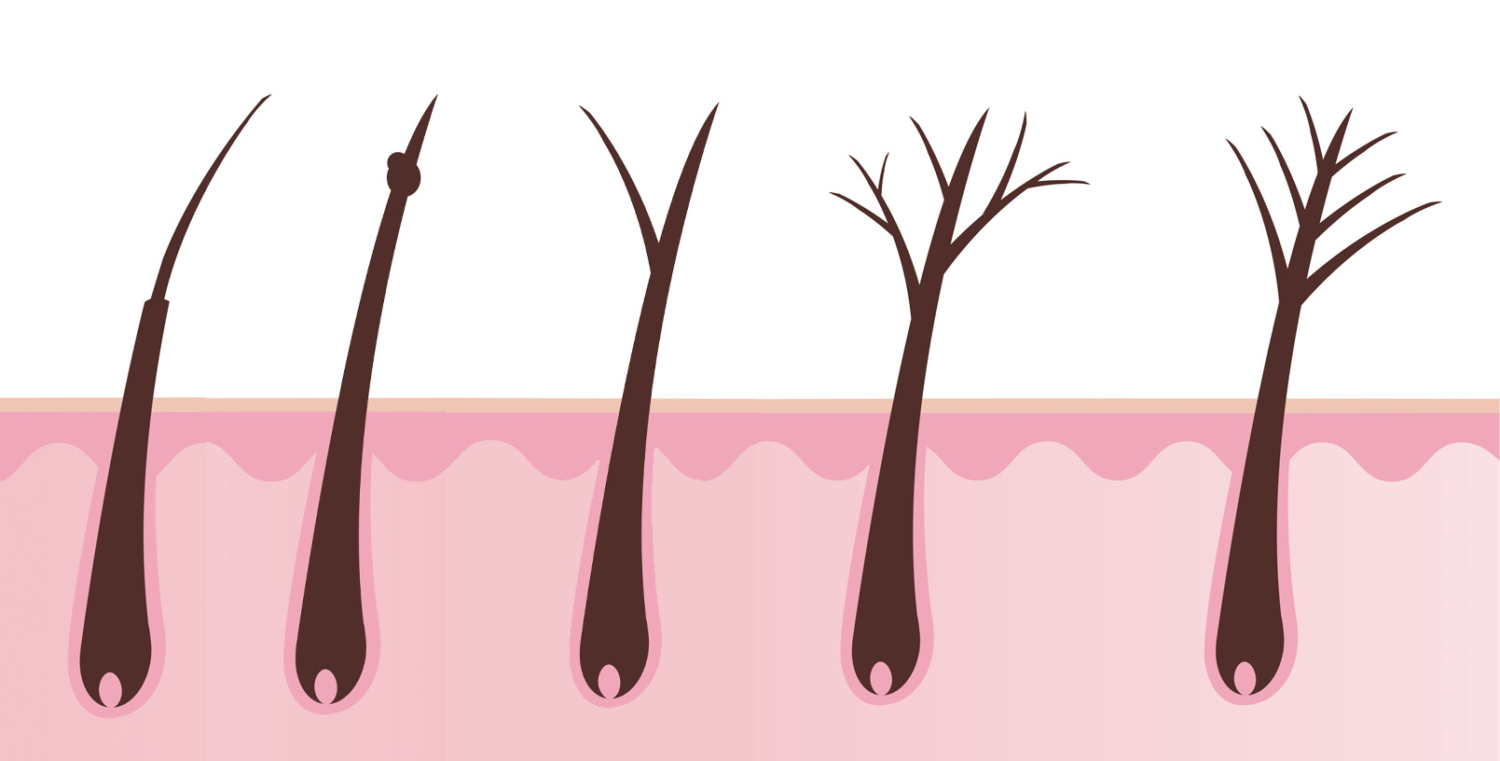 Haarspalterei: Die fünf Arten von Spliss